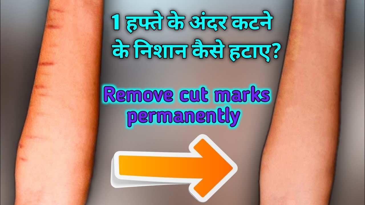 How To Remove Cut Marks Remove Cut Marks In 7 Days YouTube How To Remove Cut Marks Remove Cut Marks In 7 Days YouTube