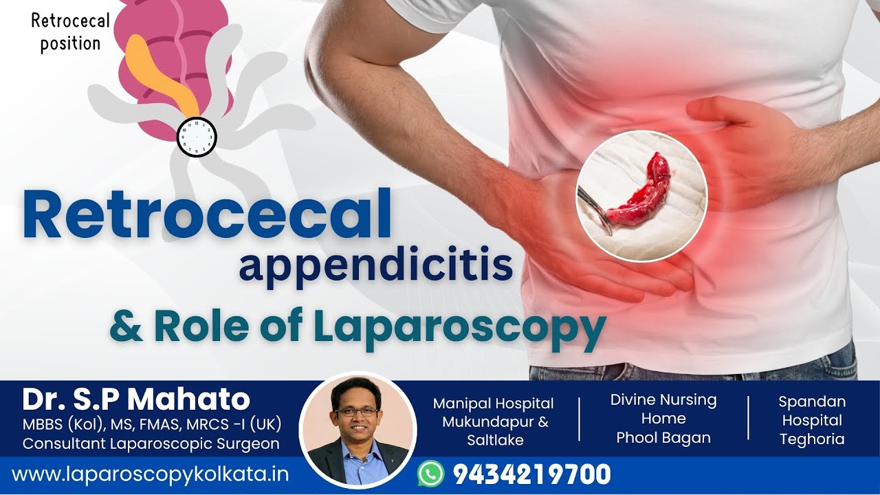What is Retrocecal Appendicitis & the role of Laparoscopy in its ...