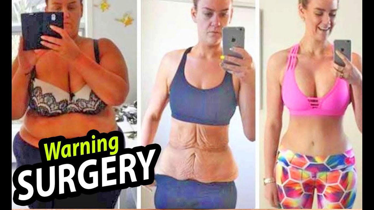 Gastric Bypass Surgery Everything You Need To Know Youtube