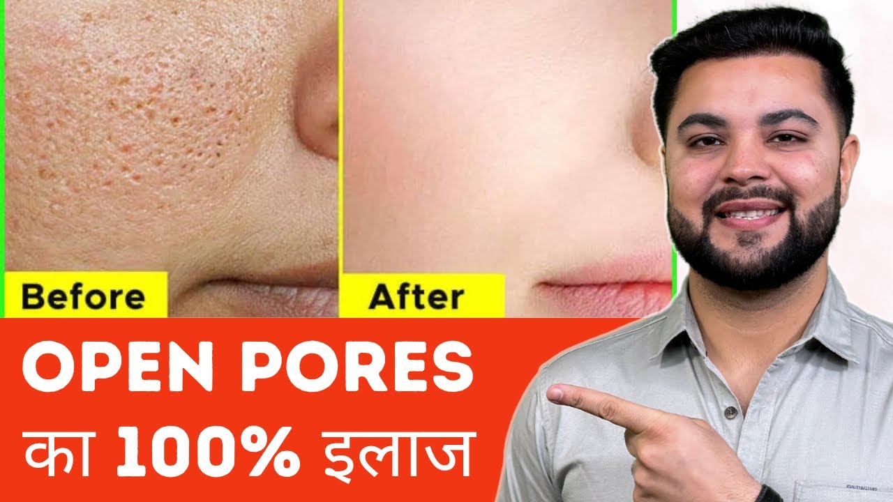 Open Pores, Clogged Pores & Blackheads का 100% इलाज - YouTube