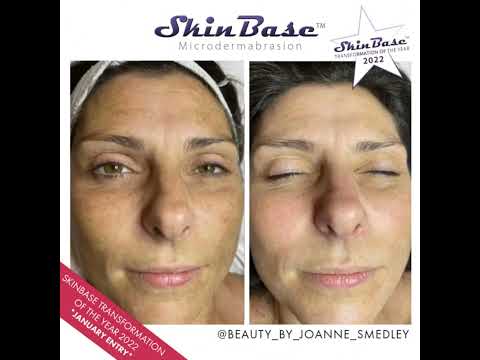 Transformation of the Year - Before and After Microdermabrasion - YouTube