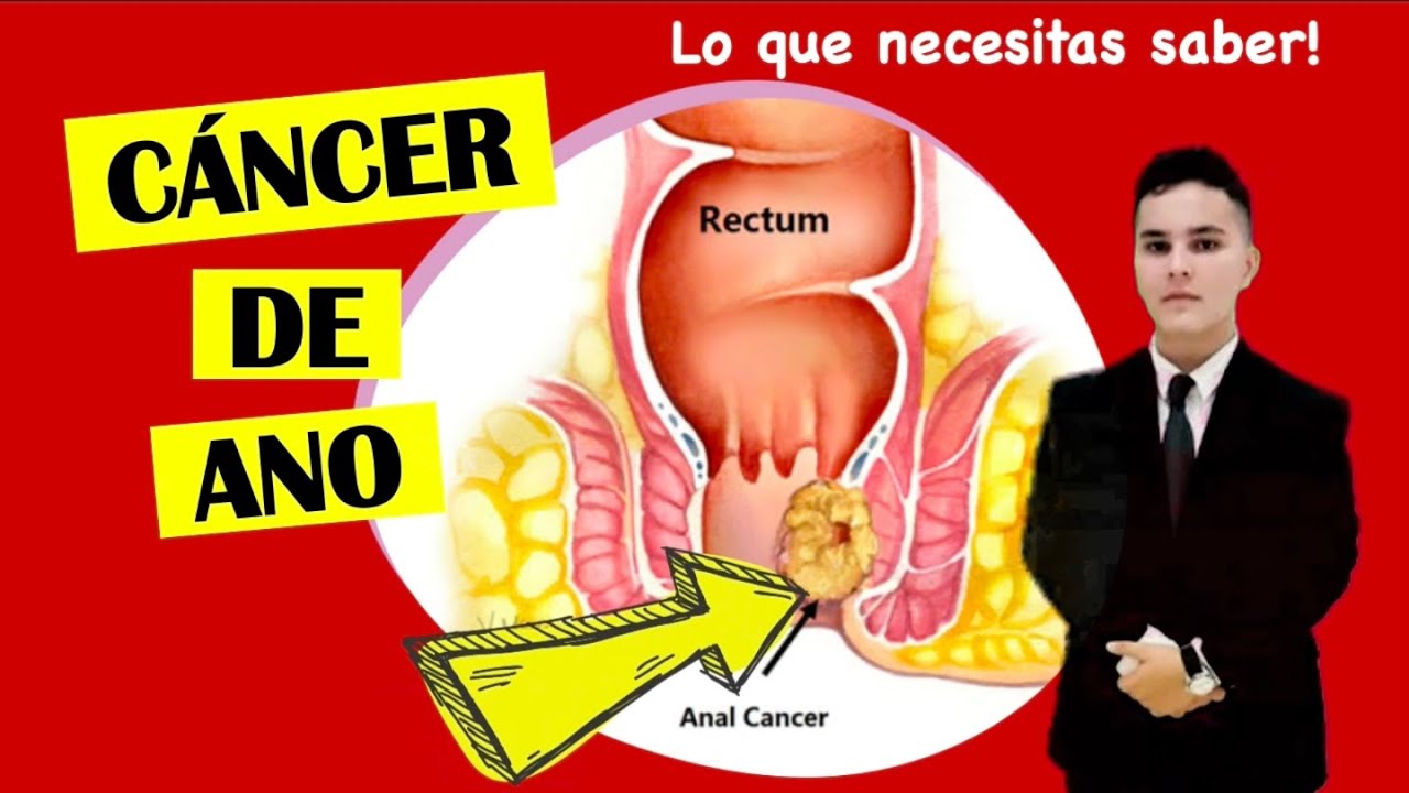 ¿Cáncer de ano? - YouTube