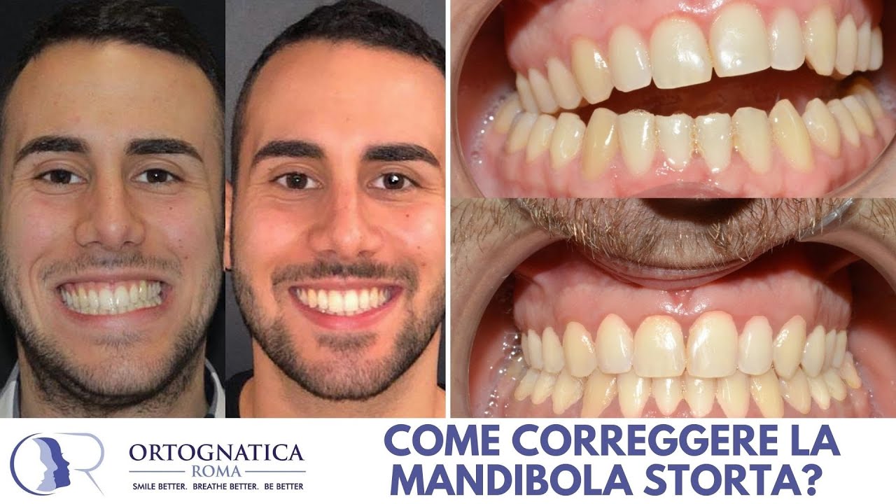 Come correggere la mandibola storta? - YouTube