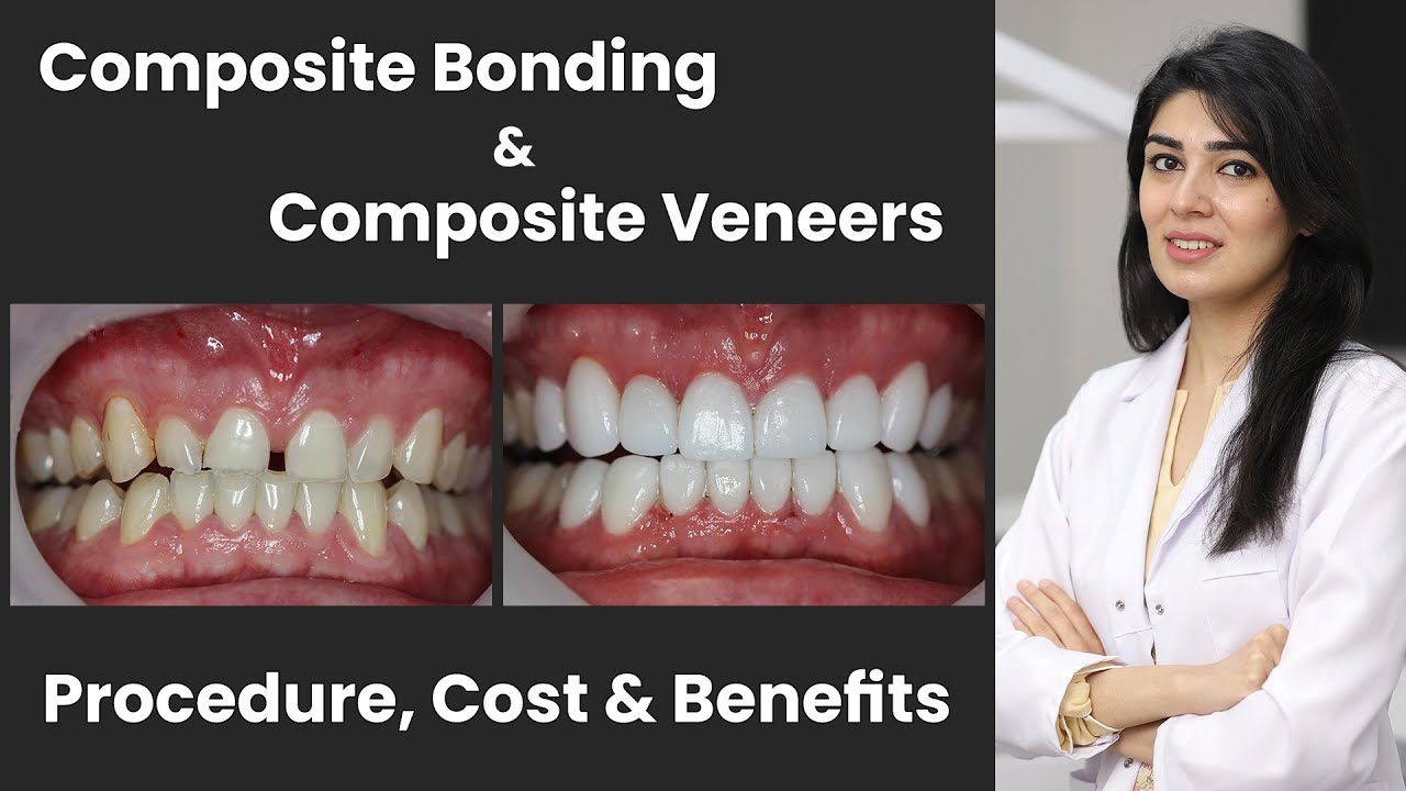 What is Composite Bonding & Composite Veneers? | Procedure, Price ...
