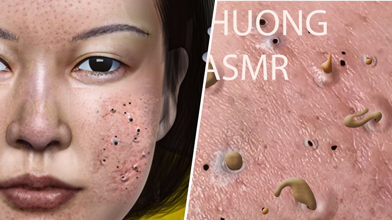 Skin Care Animation丨Pimple popping丨Acne treatment | 스킨케어 애니메이션丨여드름 터뜨리기 ...