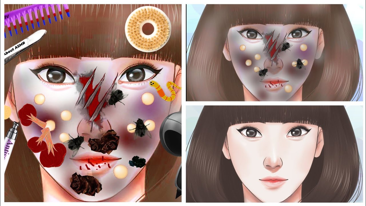 ASMR Face acne removal | Pimple remove animation | acne | 잘익은 여드름 | 블랙 ...