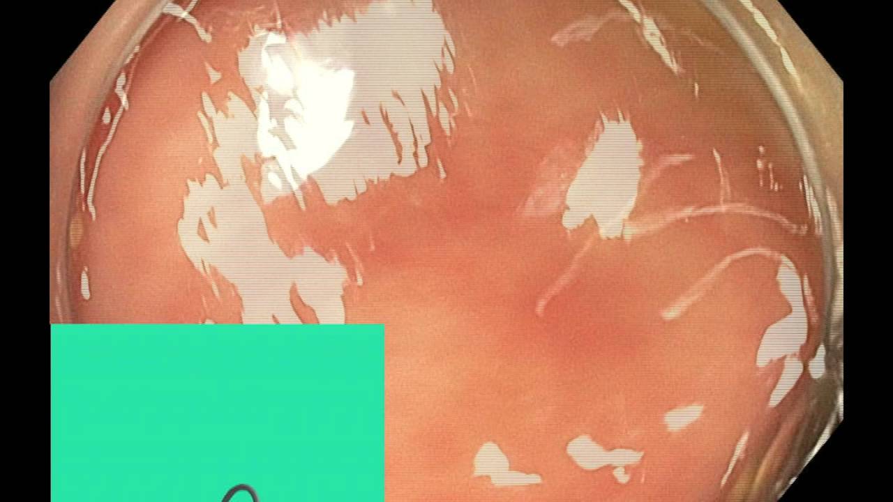 Alpha loop after pelvic surgery. Colonoscopy using Scope Guide UPD 3 ...