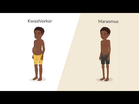 How Does Poor Nutrition Affect A Child'S Physical Development