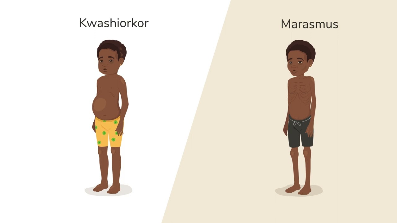 Kwashiorkor DOC) AN INVESTIGATION INTO THE CAUSES AND IMPLICATIONS OF
