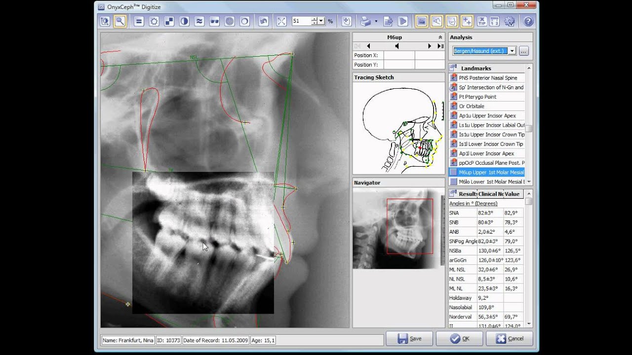 Cephalometric Analysis OnyxCeph³ - YouTube