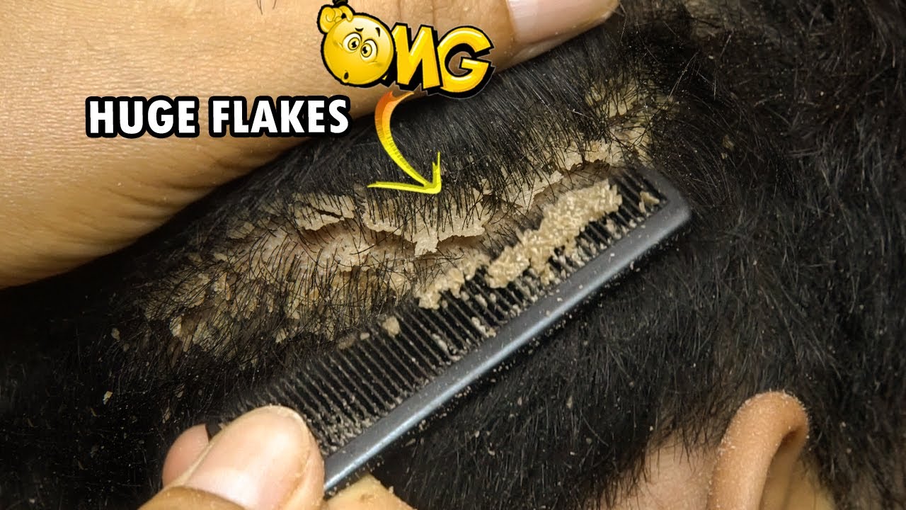 So Much Huge Dandruff Flakes On Scalp Removal #428 - YouTube
