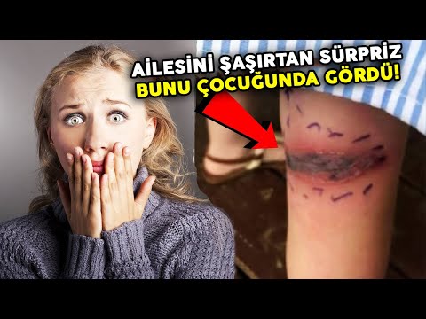 İlk Başta Annem Bunun Sıradan Böcek Isırıkları Olduğunu Düşündü, Ama Doktor Farklı Bir Şey Söyledi!