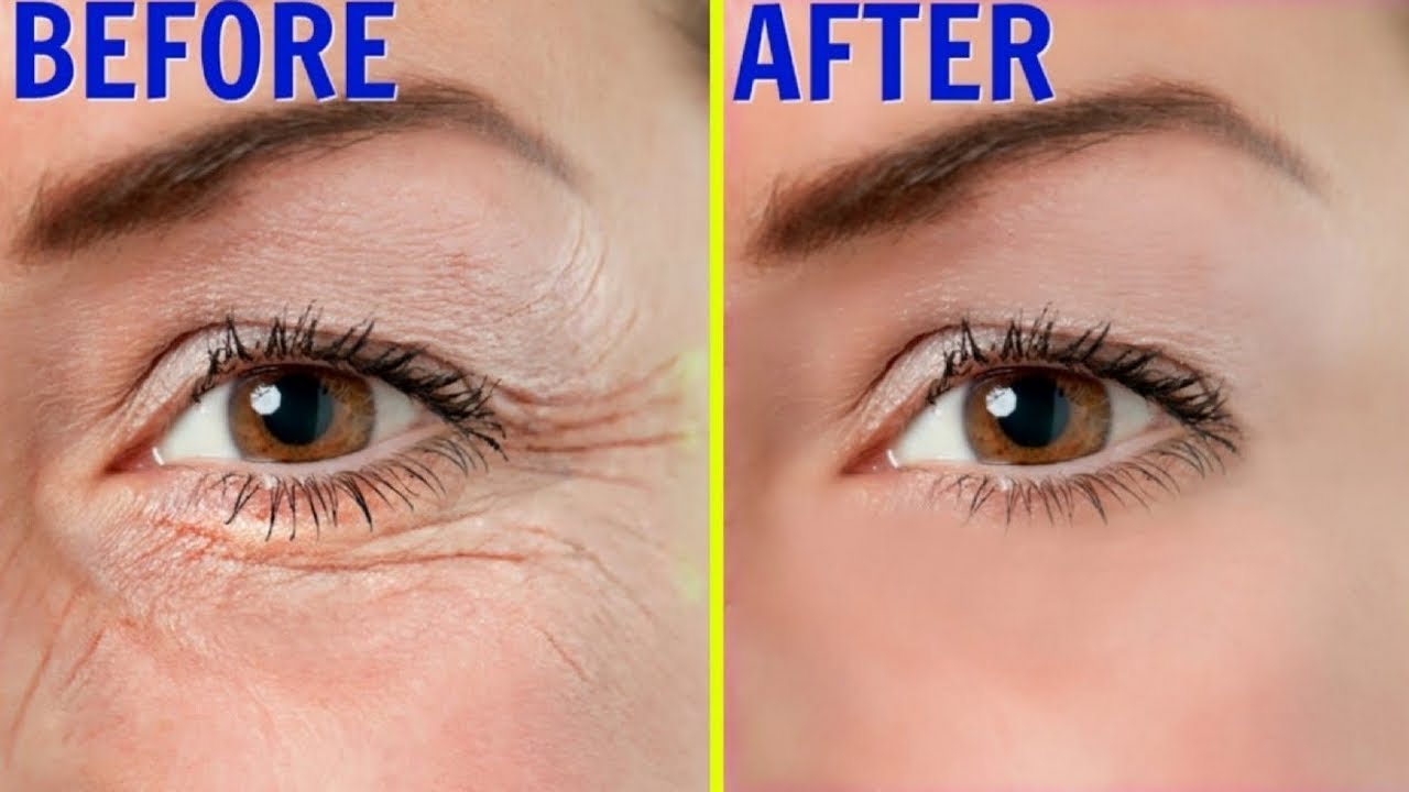 REMOVE WRINKLES INSTANTLY Get Instant Face Lift Naturally Homemade ...