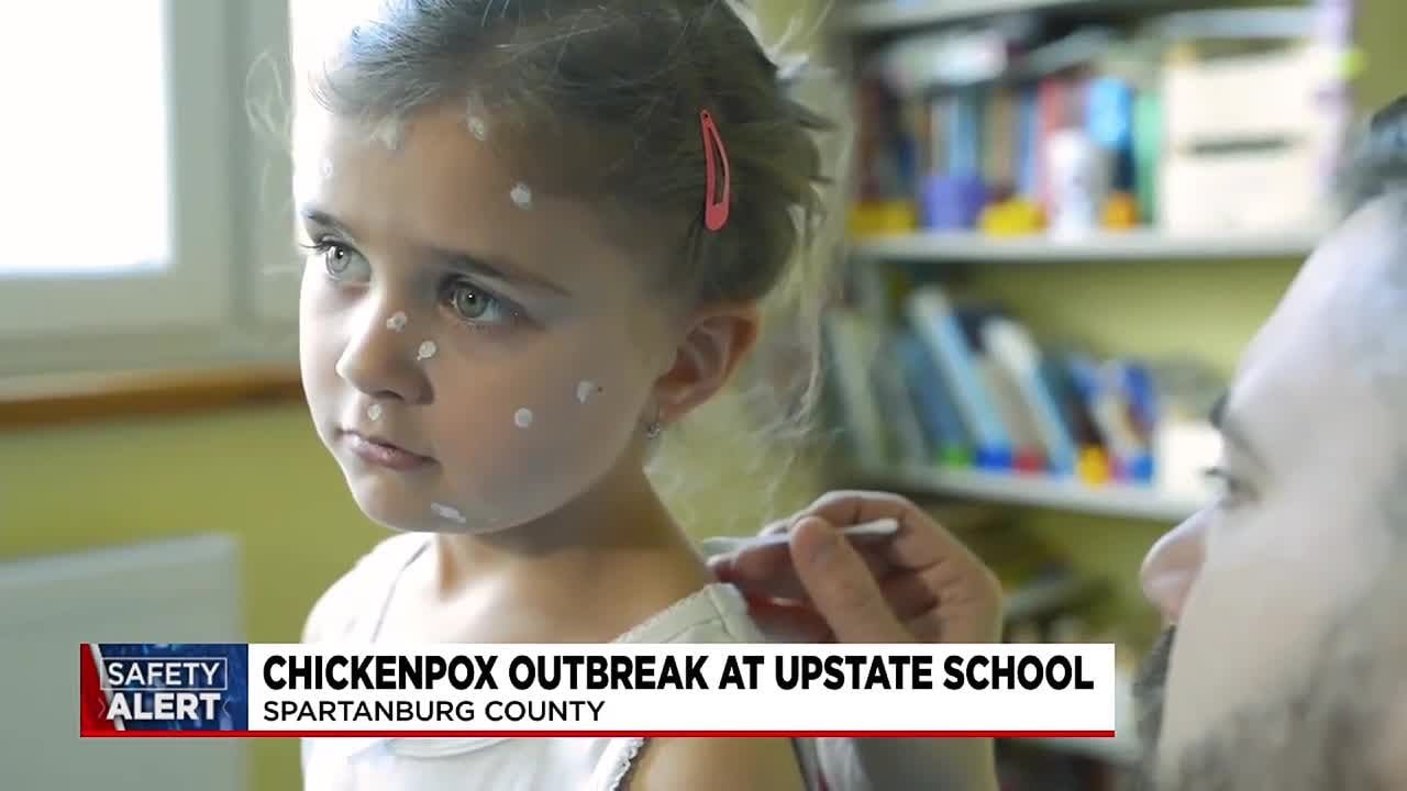 Chickenpox outbreak at upstate school - YouTube