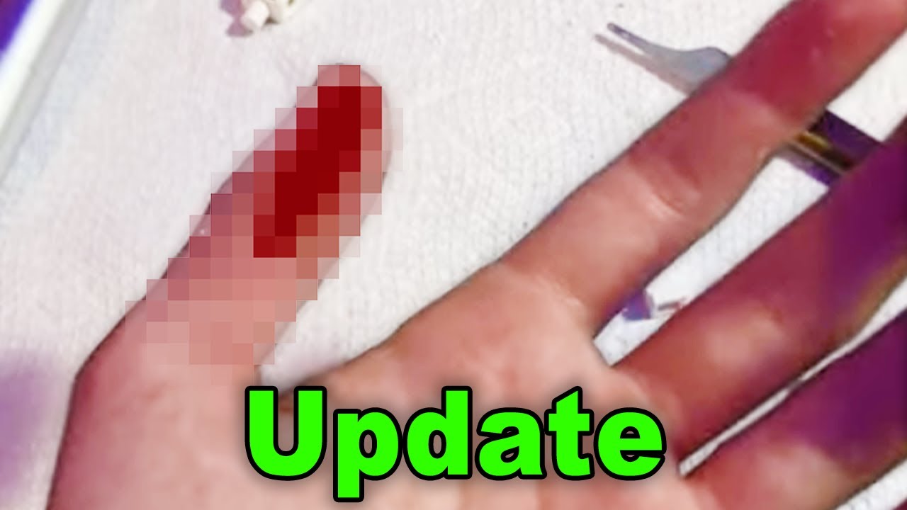 LEGO Streaming Injury Update - YouTube
