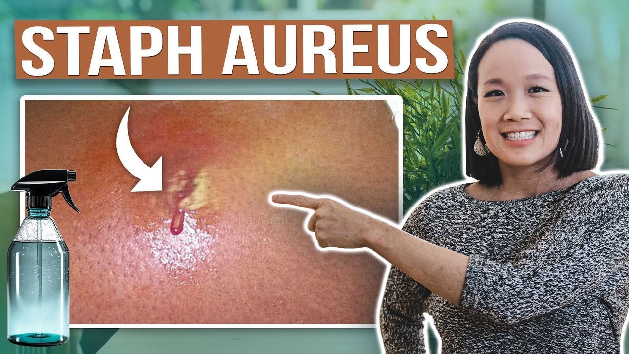 How to Deal with Staph Aureus during Eczema Outbreaks - Holistic ...