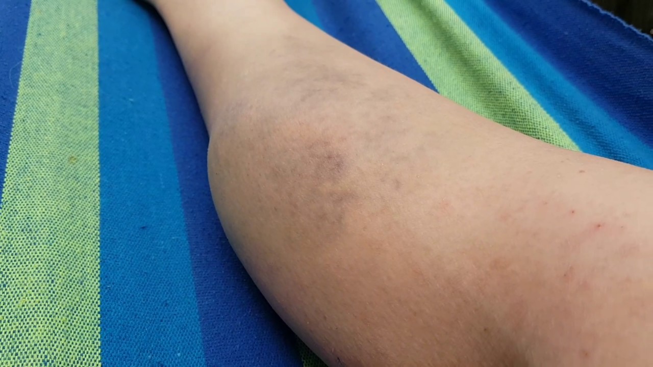 Crazy leg cramp worms in my calf - YouTube