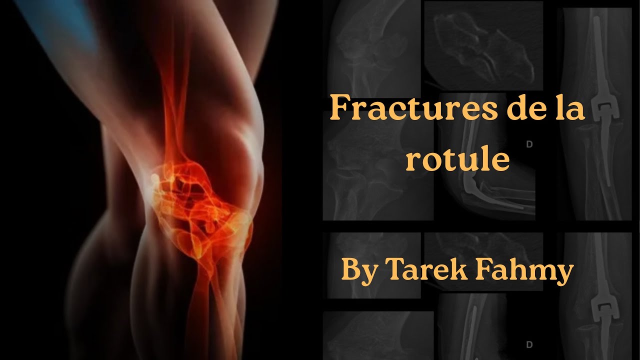 les fractures de la rotule - YouTube