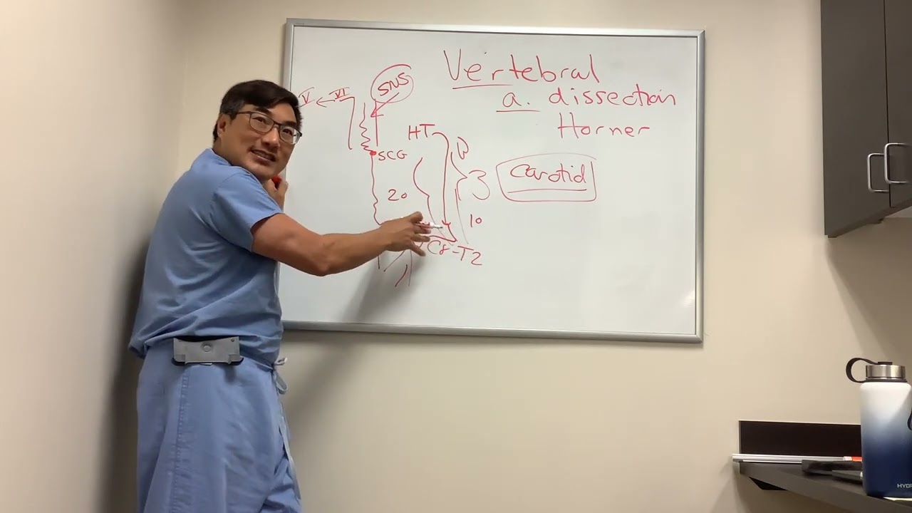 Vertebral artery dissection causing Horner Syndrome - YouTube