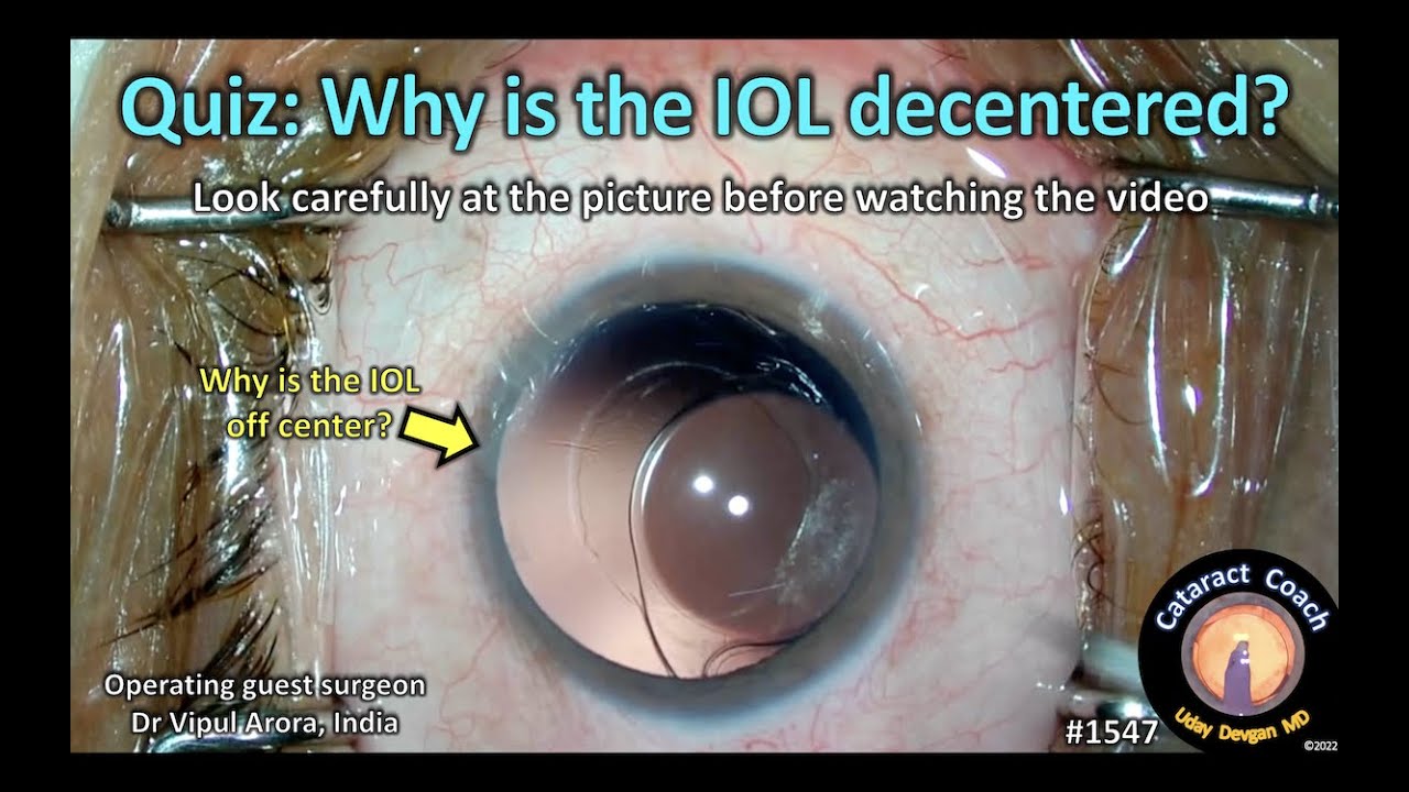 CataractCoach 1547: Quiz: Why is the IOL decentered? - YouTube