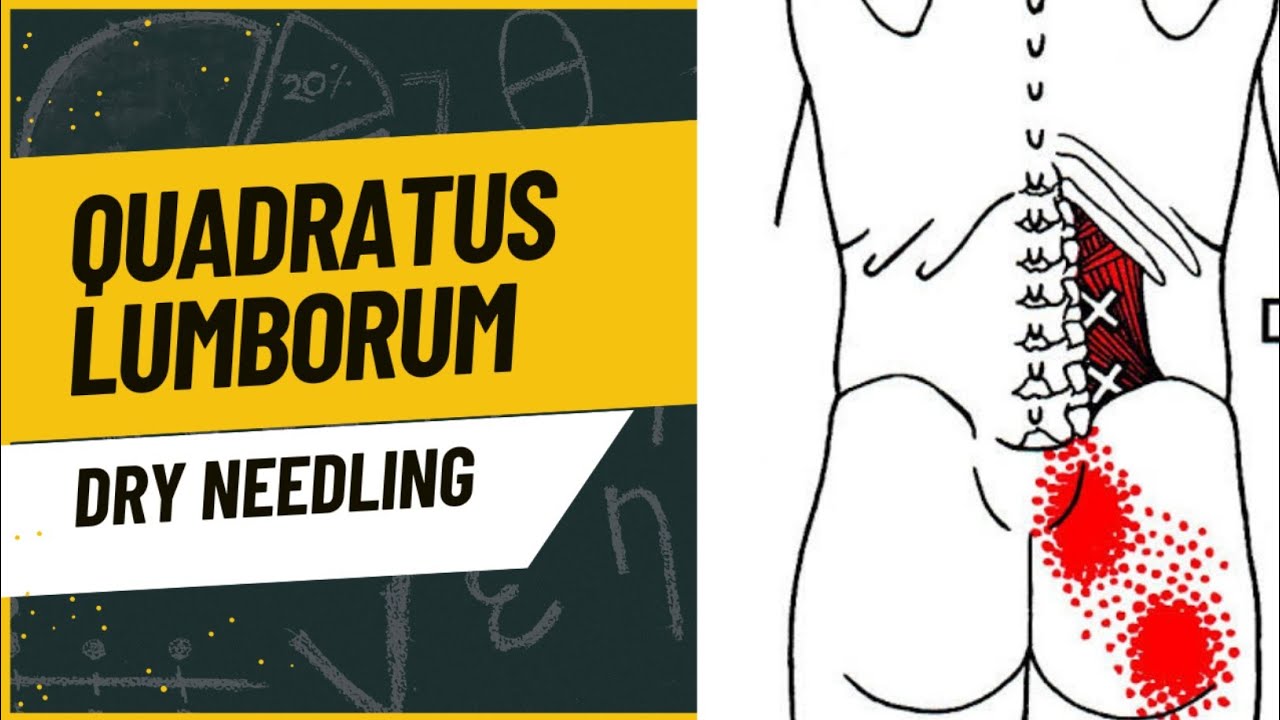 Quadratus Lumborum dry needling - YouTube