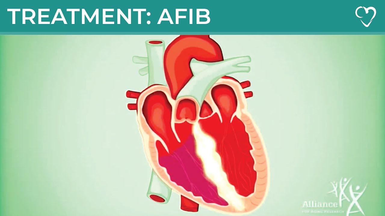 Treatment for Atrial Fibrillation (AFIB) - YouTube