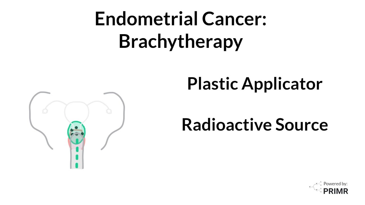 Endometrial Cancer - Brachytherapy - YouTube