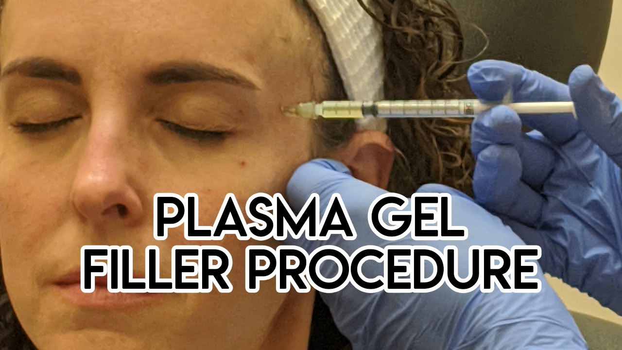 Plasma Gel Filler Procedure - YouTube