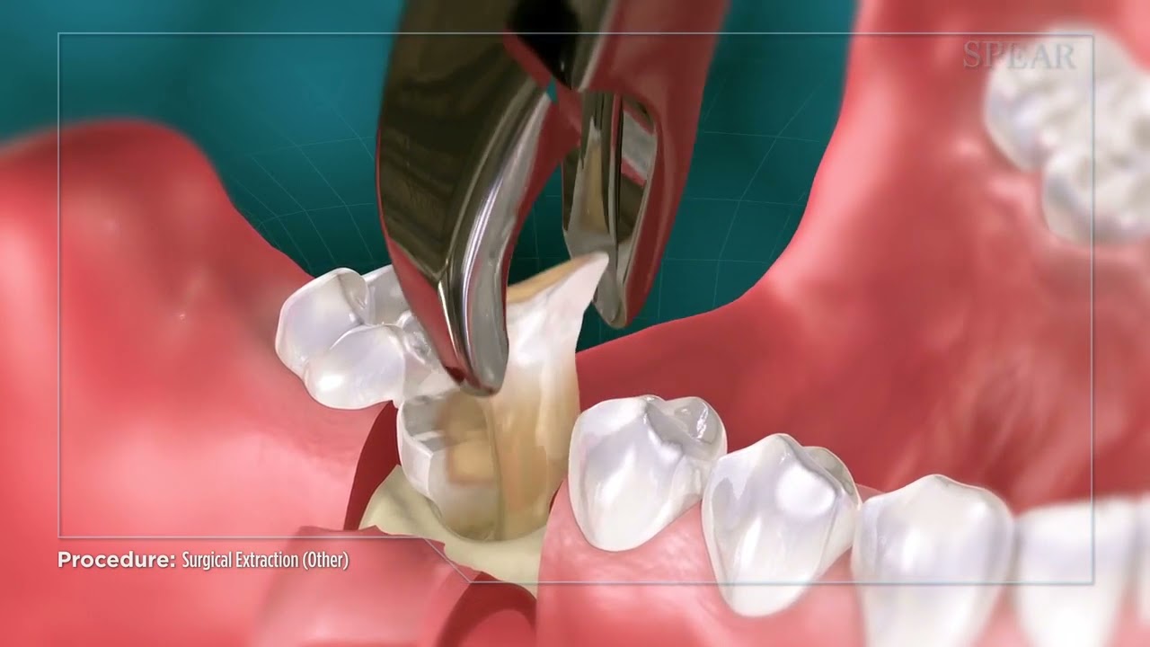 What Is A Surgical Extraction