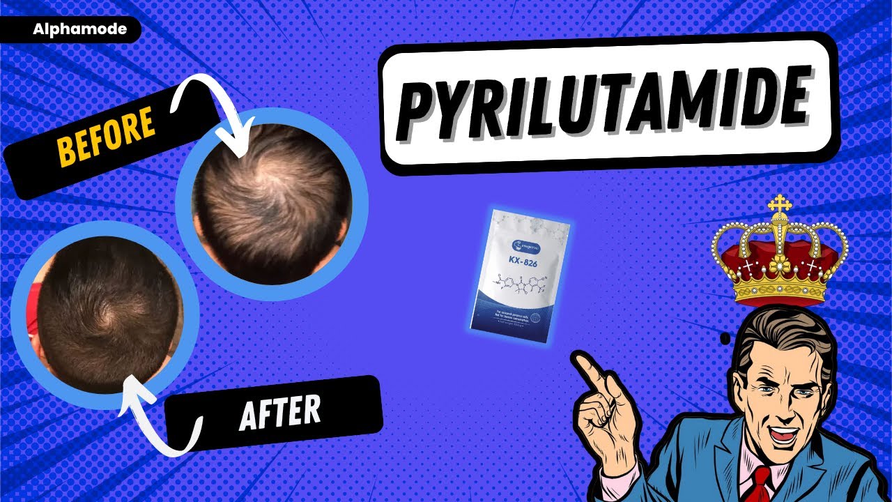 Pyrilutamide - the new hair loss treatment - YouTube