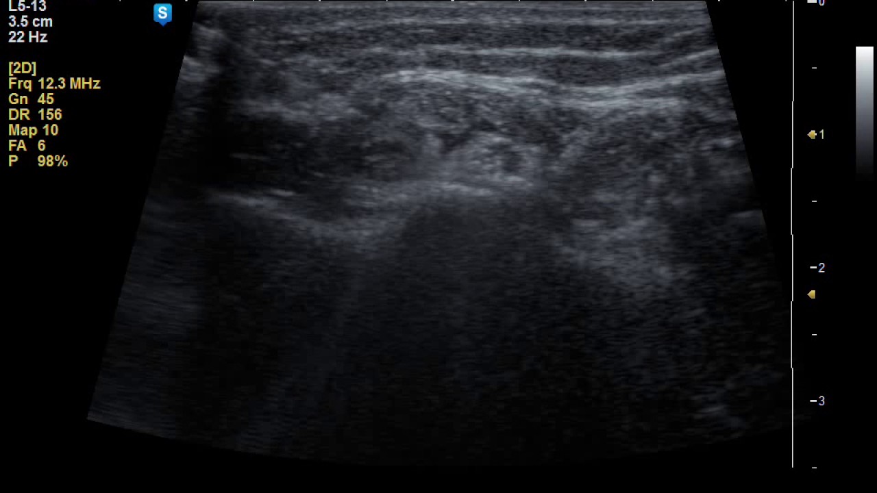 Ultrasound guided hydro-dissection of the ulnar nerve between 2 heads ...