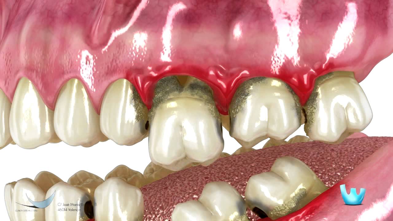 14 El Implante - YouTube