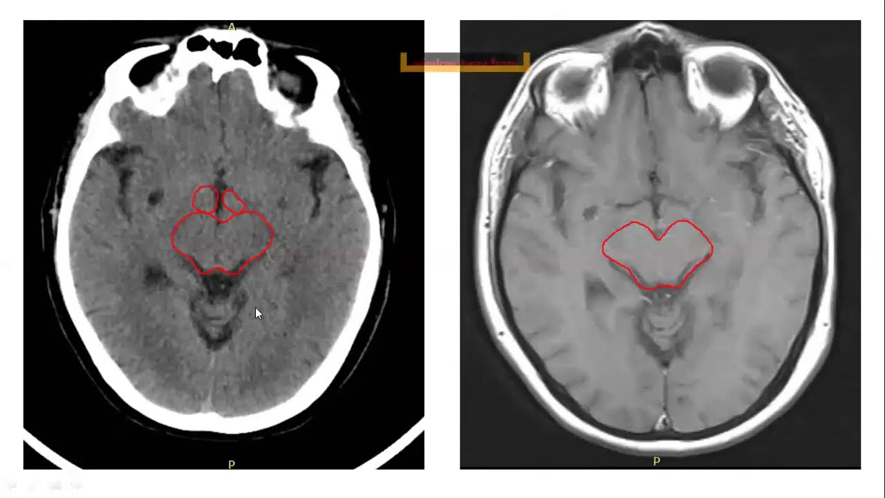 Organs at risk in Brain radiotherapy ( their constraints & how to ...