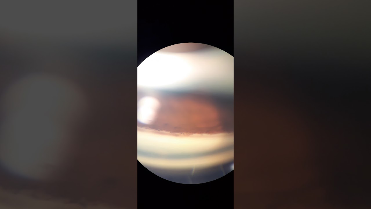 Gonioscopy using a 3 mirror Gonioscope - YouTube