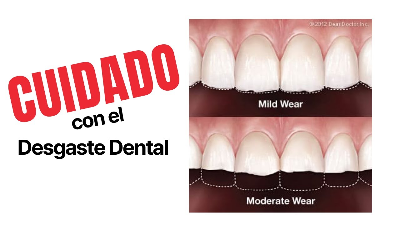 👉Dientes desgastados - Enfermedad de Desgaste Oclusal - Prótesis ...