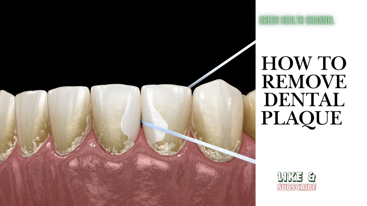 How to Remove Dental Plaque and Prevent Cavities - YouTube