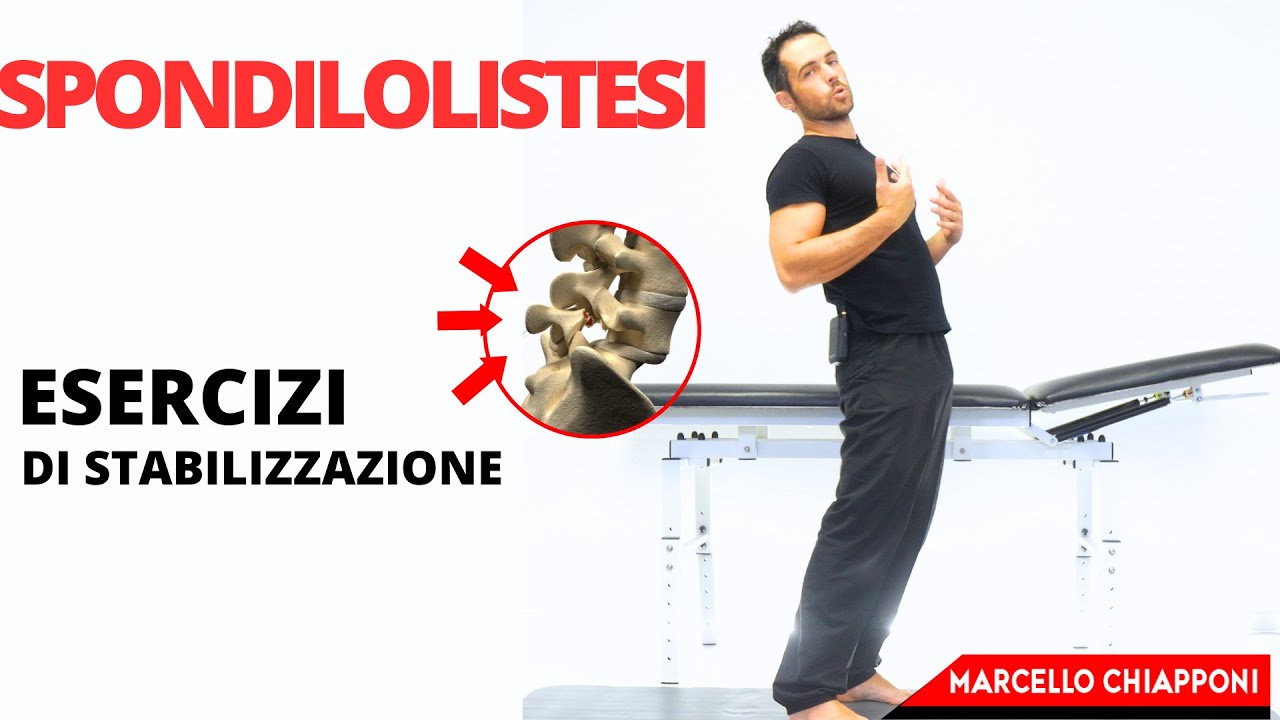 Spondilolistesi e SCIVOLAMENTI VERTEBRALI: ecco come STABILIZZARE la ...