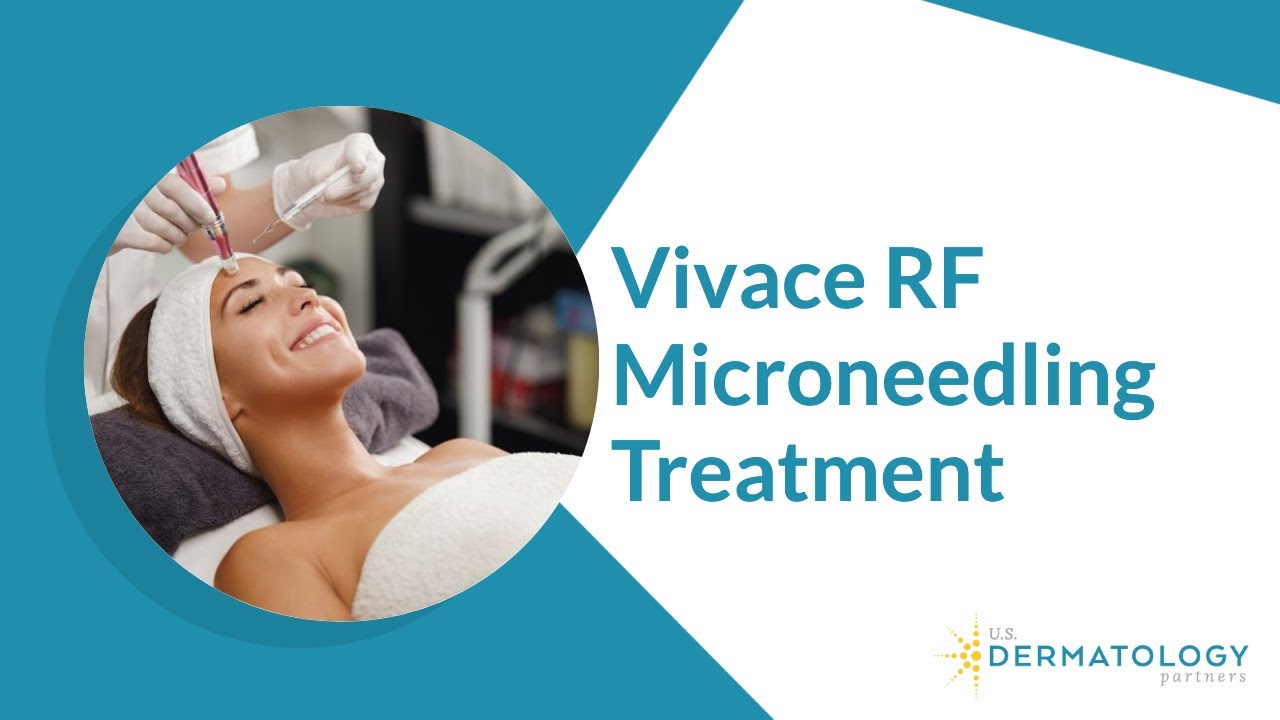 Vivace RF Microneedling Treatment - YouTube