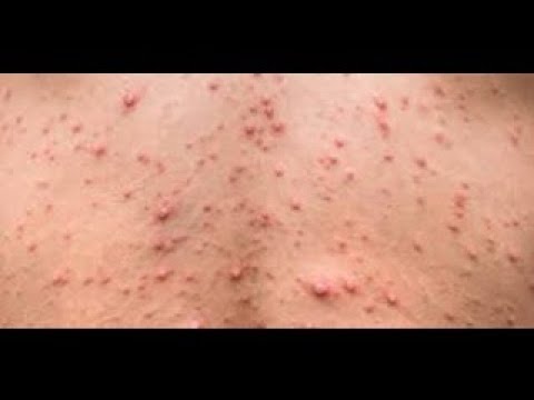 2mn pour comprendre le rash cutané - YouTube