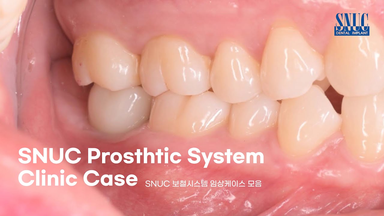 SNUC Prosthtic System (SNUC 보철시스템) Clinic Case - YouTube
