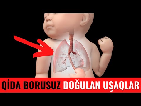Körpələrdə Qida Borusunun Anadangəlmə Atreziyası
