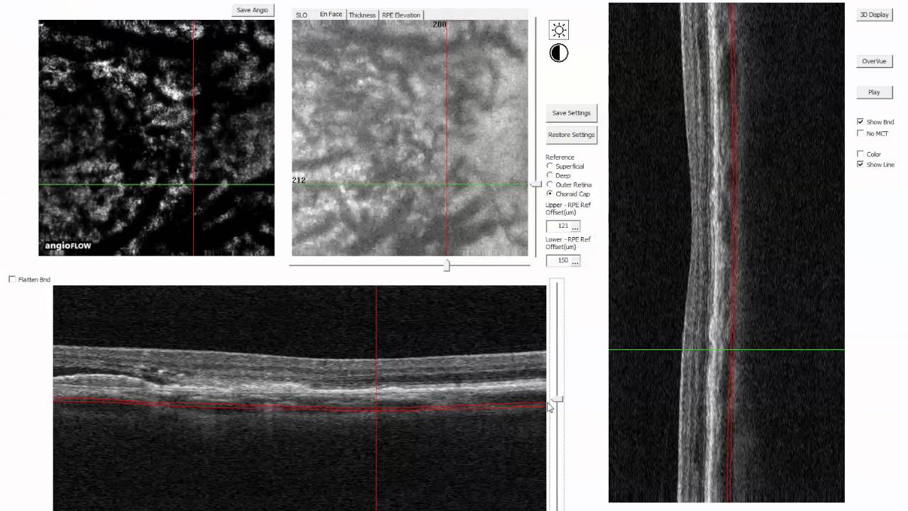 CNV_OCT_ANGIO - YouTube