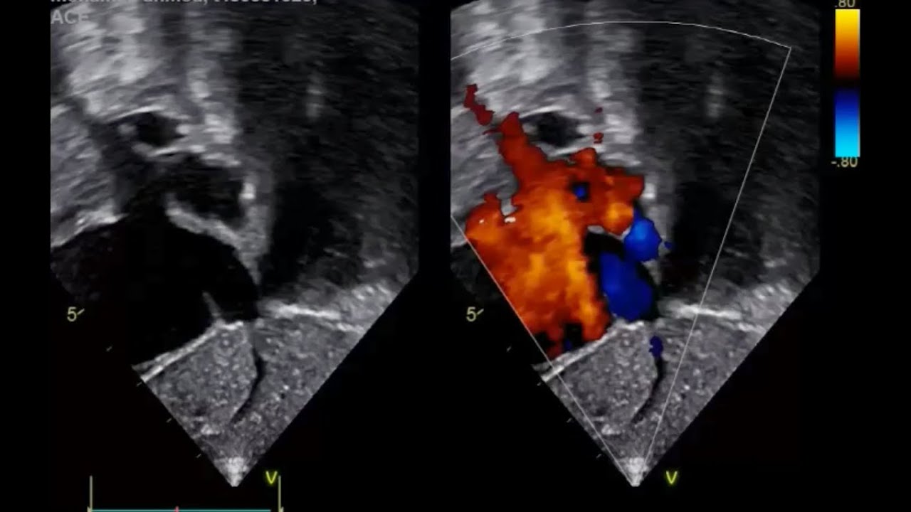 Echocardiography of Superior sinus venosus ASD - YouTube