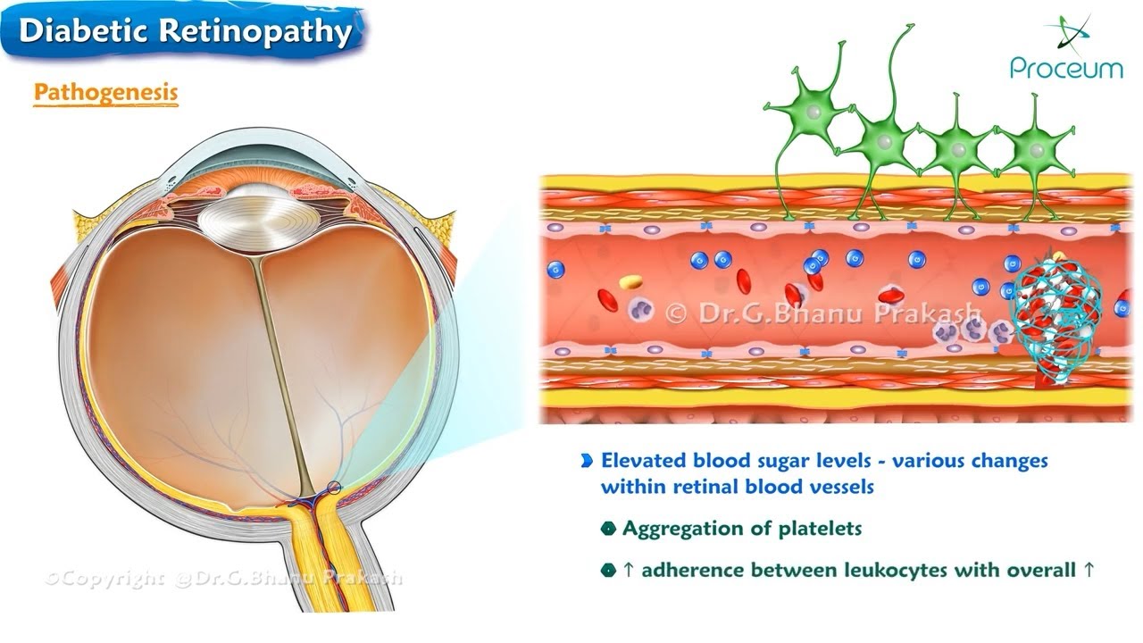 Diabetic Retinopathy : Introduction,Pathogenesis,Classification ... Diabetic Retinopathy : Introduction,Pathogenesis,Classification ...
