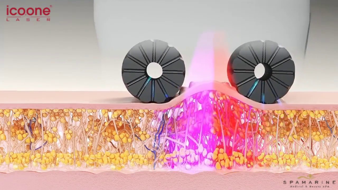 Icoone® Laser Roboderm® Tecnologia Brevettata SpaMarine di Senigallia ...