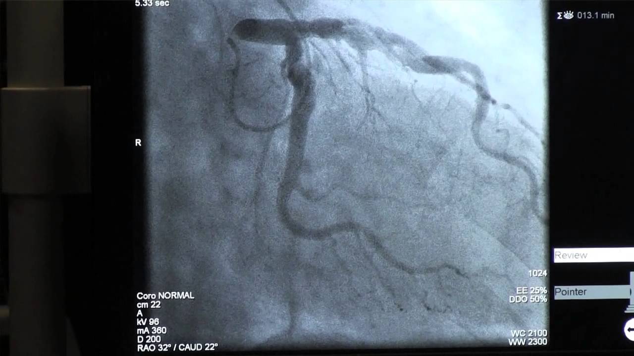 Right Heart Catheterization - YouTube