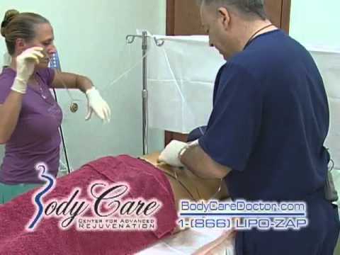 Smart Lipo Procedure Abs & Flanks - YouTube