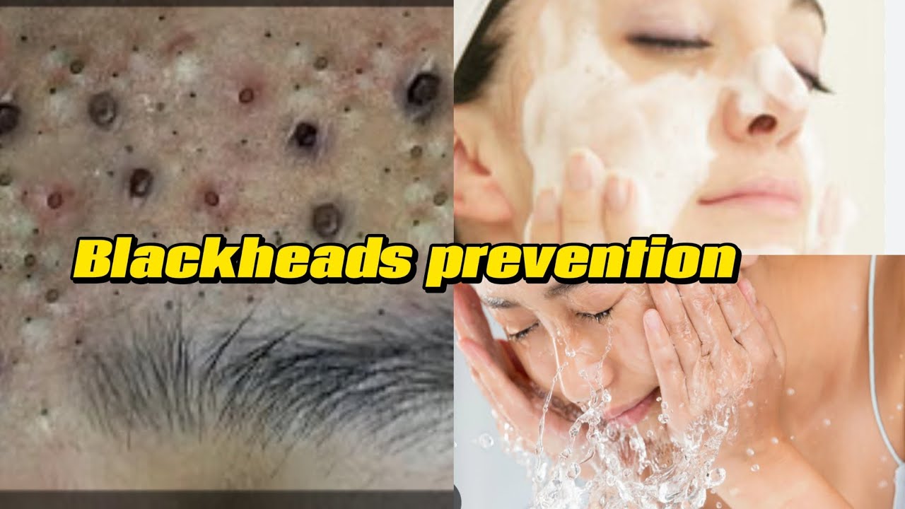 Easy Ways to prevent Blackheads formation on your Skin. - YouTube
