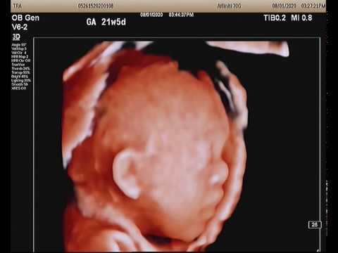 Fetus 22wks, aberrant right subclavian artery, thick nuchal fold, thick ...