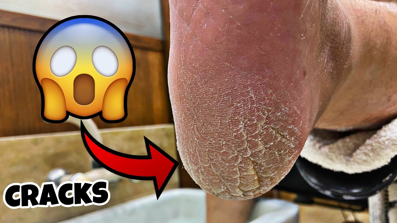 foot heel dead skin remover / scrape skin treatment - YouTube
